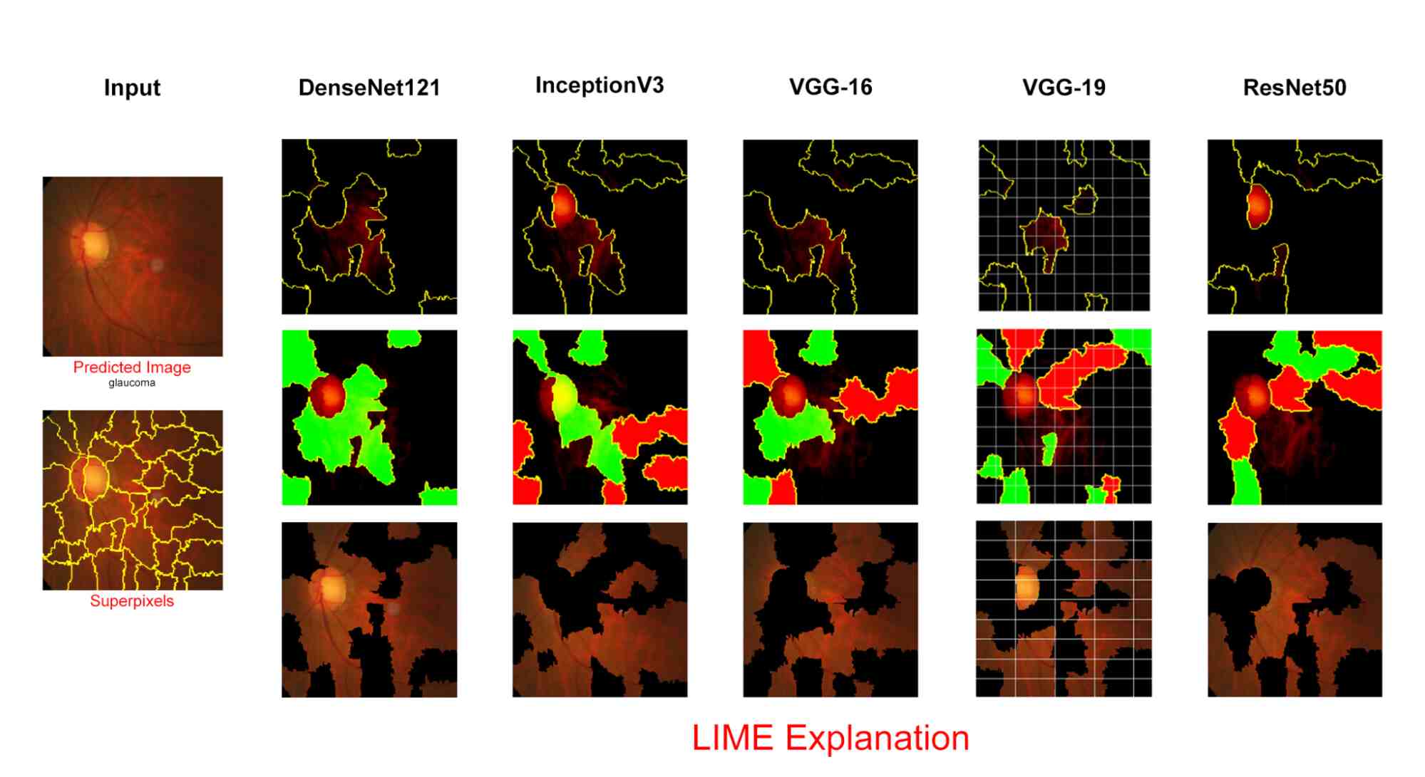 Explainable AI based Glaucoma Detection using Transfer Learning and ... Explainable AI based Glaucoma Detection using Transfer Learning and ...