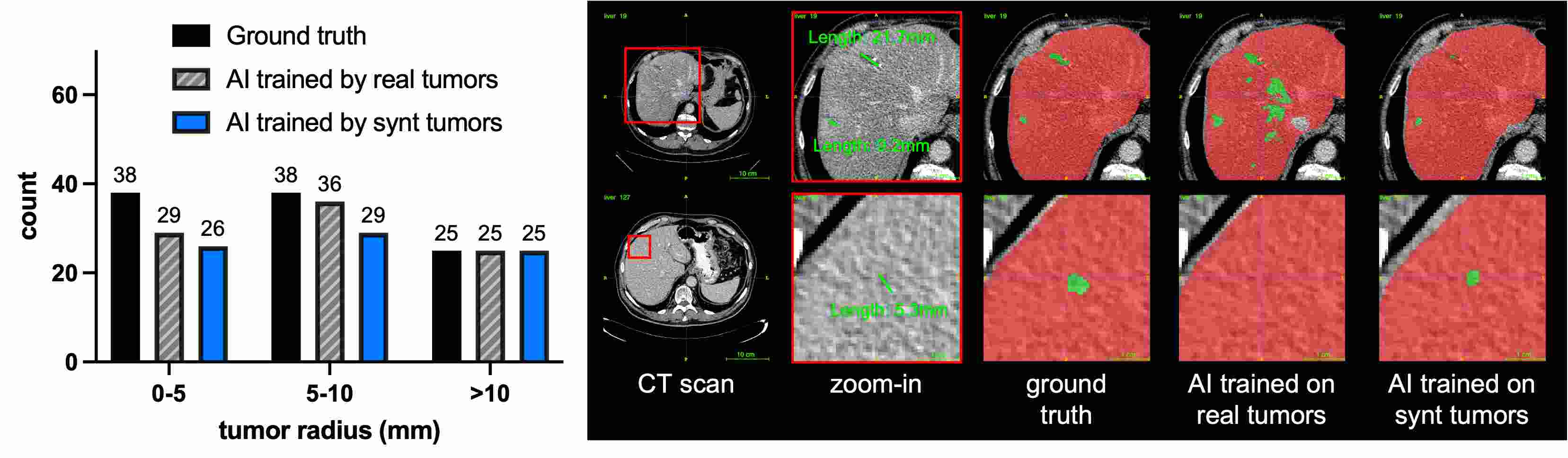 Synthetic Tumors Make AI Segment Tumors Better | DeepAI