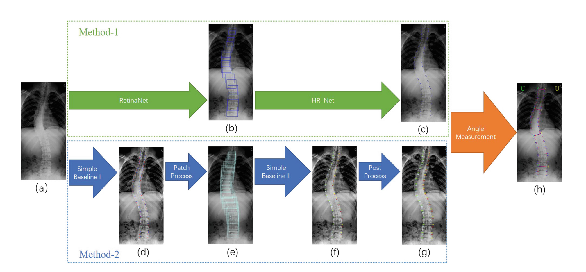 Scoliosis Detection using Deep Neural Network | DeepAI