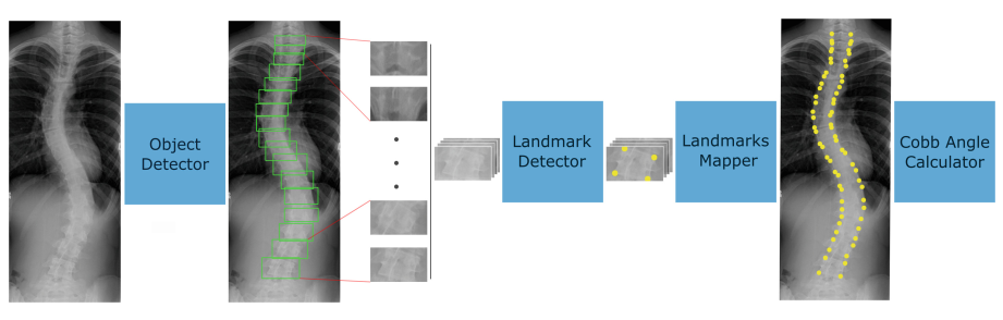 Scoliosis Detection using Deep Neural Network | DeepAI