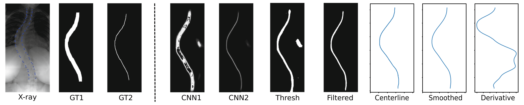 Scoliosis Detection using Deep Neural Network | DeepAI