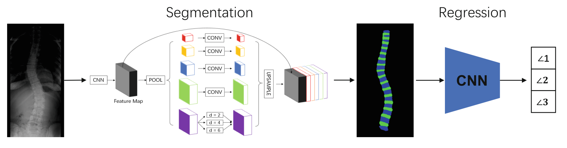 Scoliosis Detection using Deep Neural Network | DeepAI
