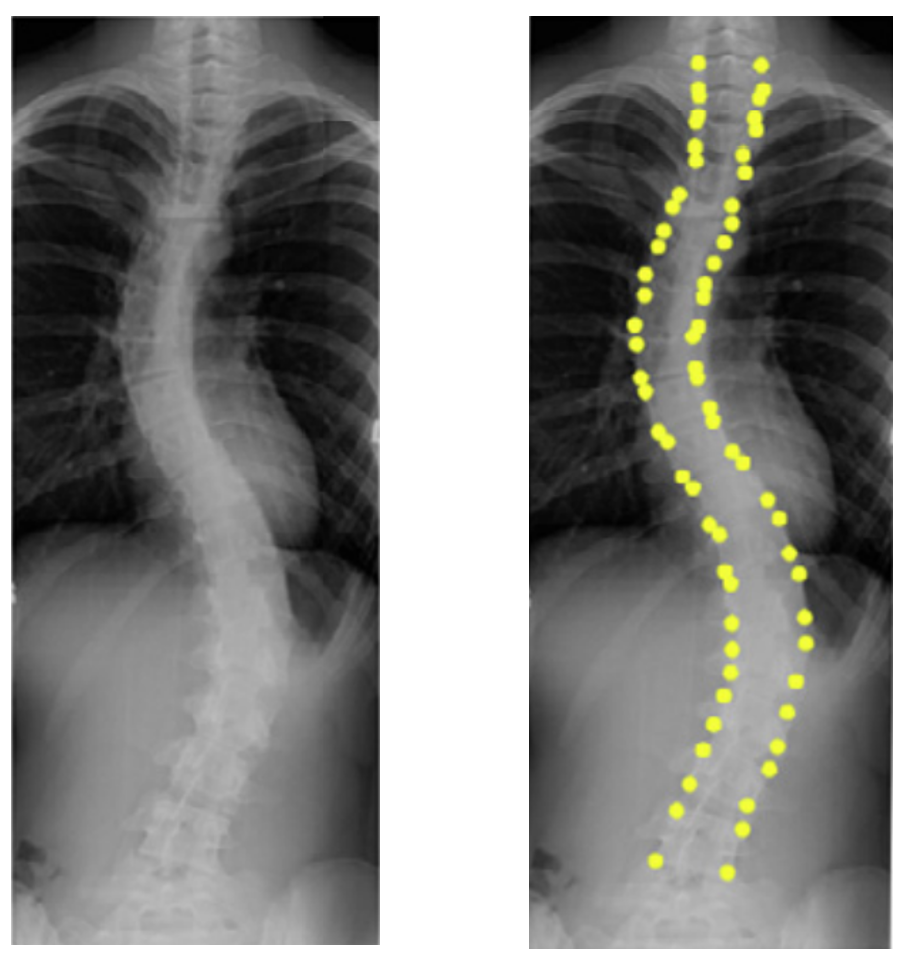 Scoliosis Detection using Deep Neural Network | DeepAI
