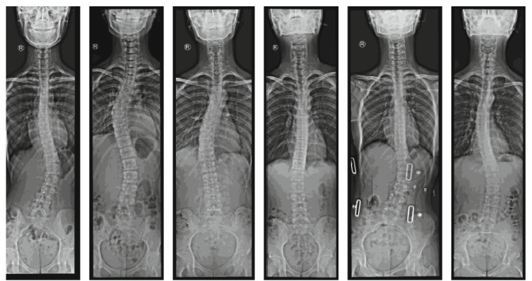 Scoliosis Detection using Deep Neural Network | DeepAI