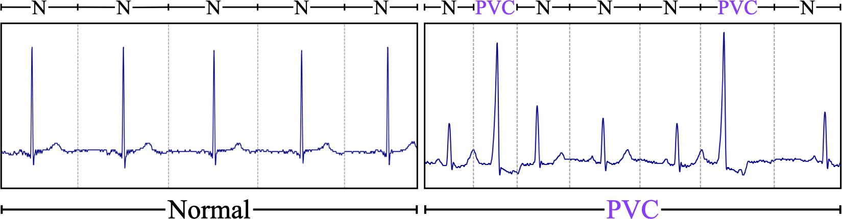 Evaluating Feature Attribution Methods For Electrocardiogram Deepai