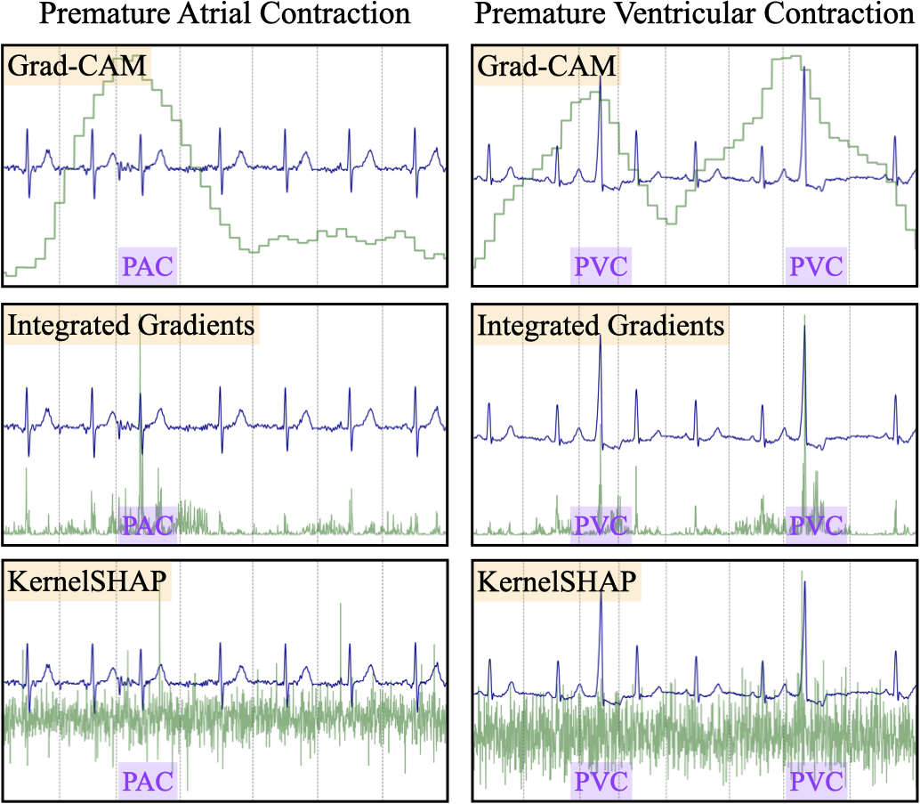 Evaluating Feature Attribution Methods For Electrocardiogram Deepai 