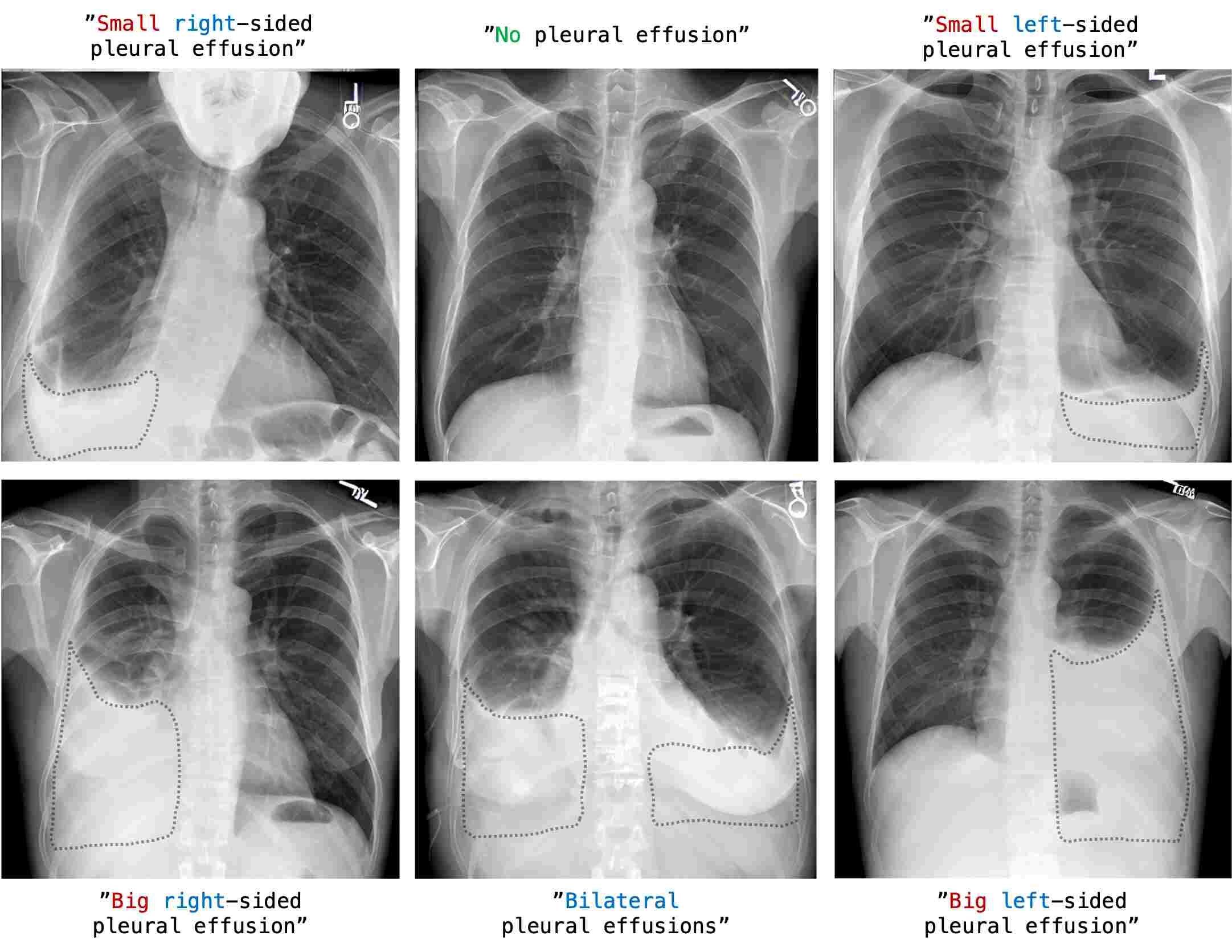 RoentGen: Vision-Language Foundation Model for Chest X-ray Generation ...