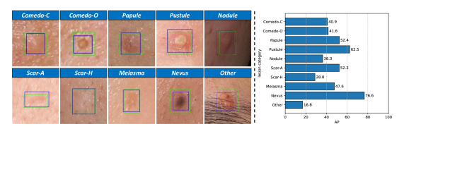 Towards Accurate Acne Detection Via Decoupled Sequential Detection Head Deepai