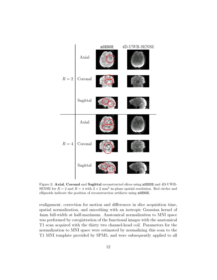 4d Wavelet Based Regularization For Parallel Mri Reconstruction Impact On Subject And Group