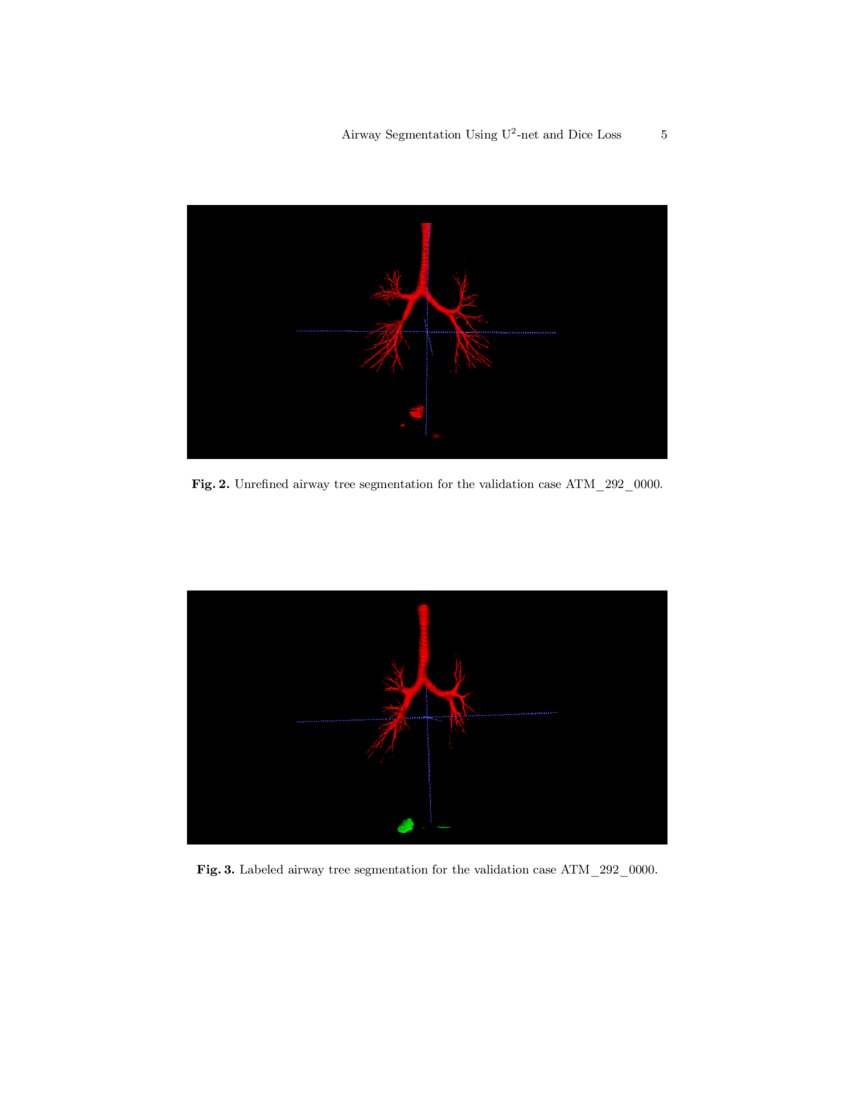 A CT-Based Airway Segmentation Using U^2-net Trained by the Dice Loss Function | DeepAI
