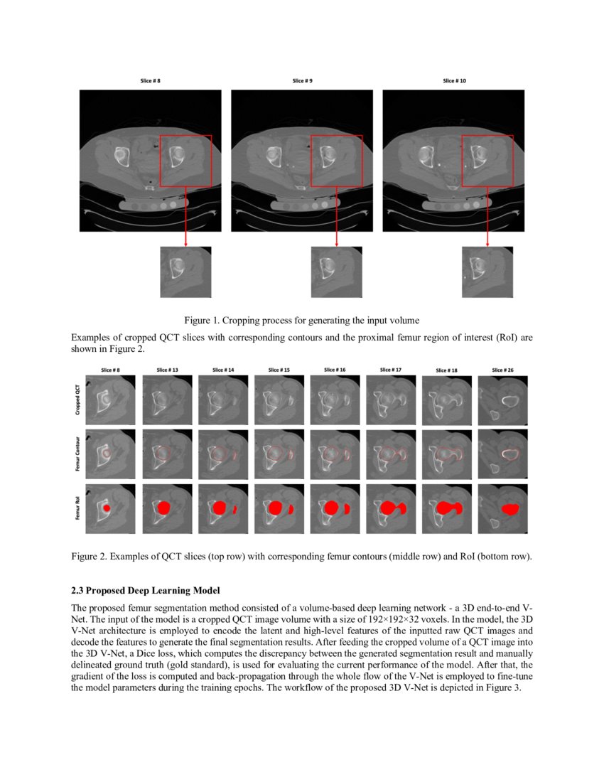 A Deep Learning Based Method For Automatic Segmentation Of Proximal Femur From Quantitative