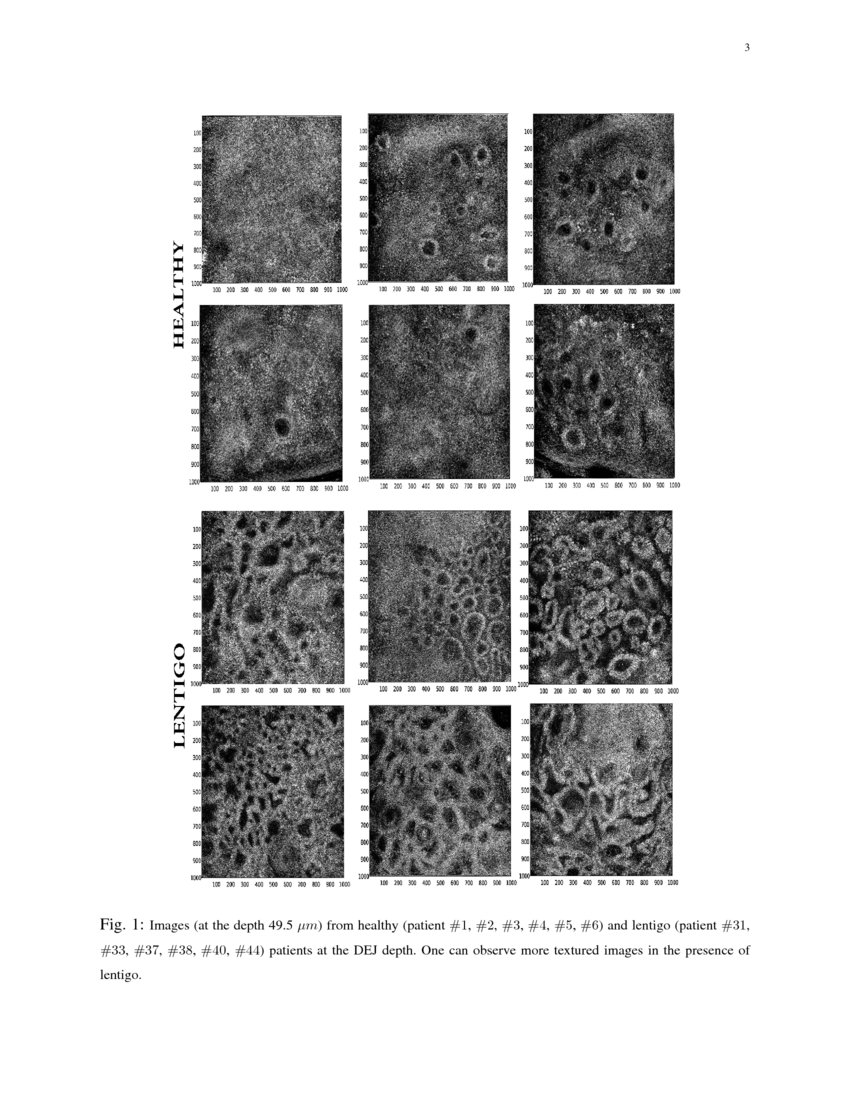 An unsupervised bayesian approach for the joint reconstruction and classification of cutaneous ...