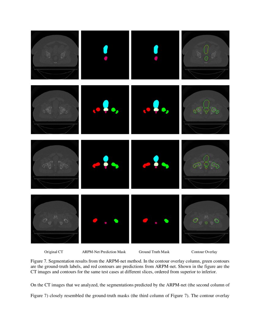 ARPM-net: A novel CNN-based adversarial method with Markov Random Field enhancement for prostate ...