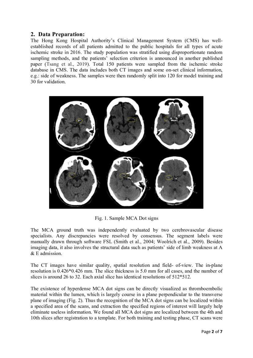 Automated Segmentation For Hyperdense Middle Cerebral Artery Sign Of Acute Ischemic Stroke On