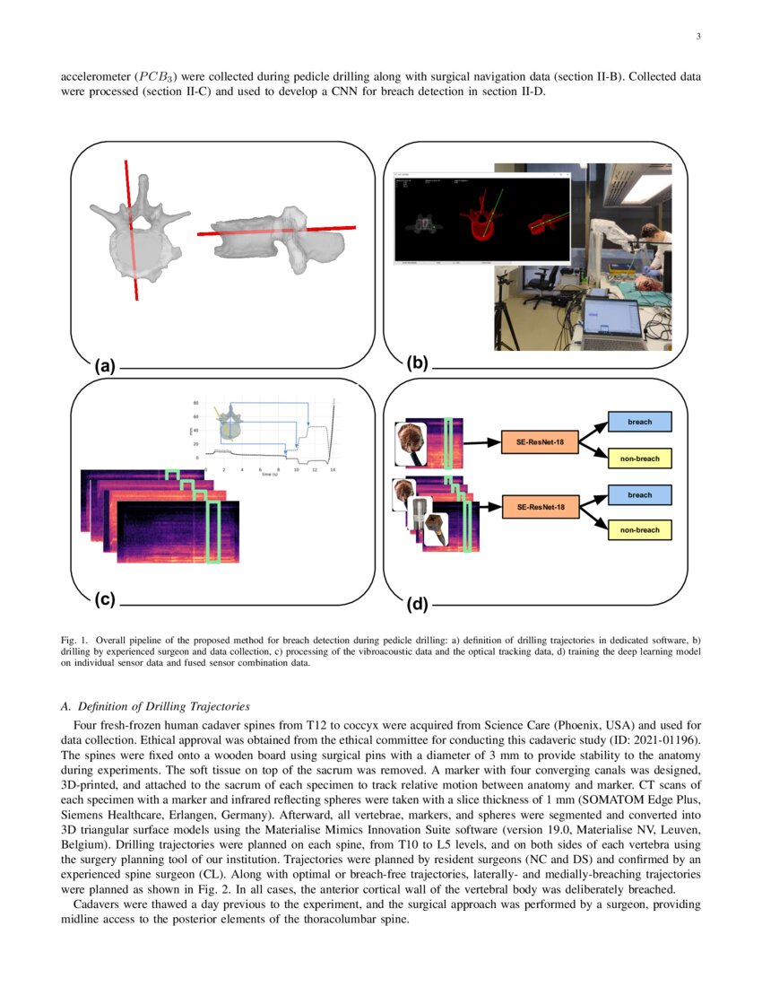 Automatic breach detection during spine pedicle drilling based on ...