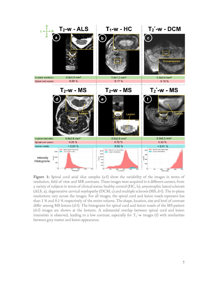 Automatic Segmentation Of The Spinal Cord And Intramedullary Multiple