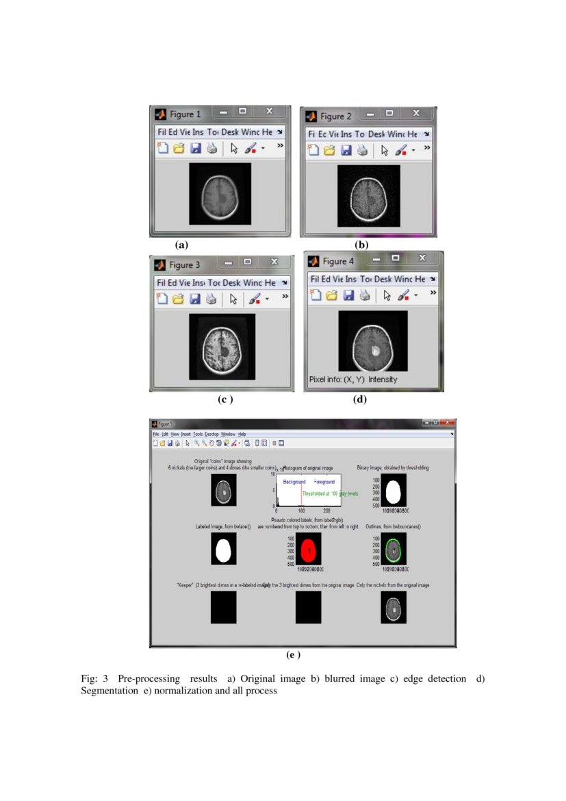 Brain Tumor Mri Image Classification With Feature Selection And Extraction Using Linear