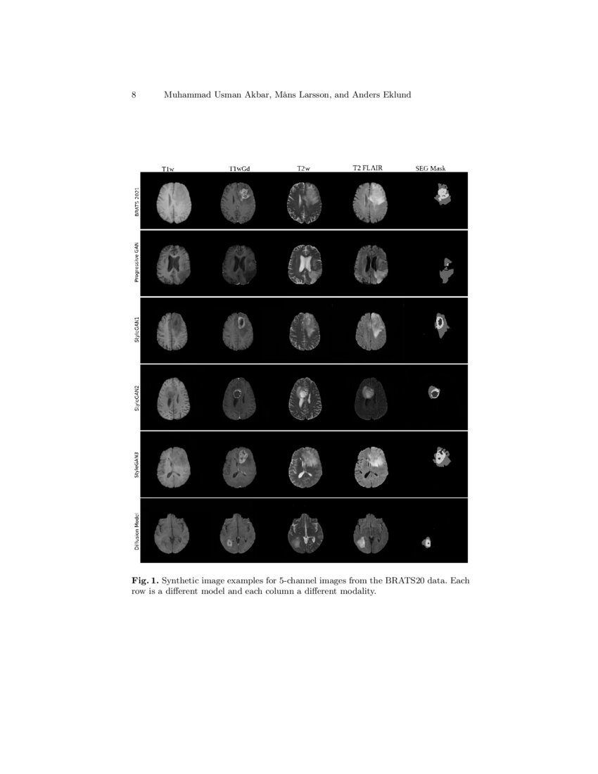 Brain Tumor Segmentation Using Synthetic Mr Images A Comparison Of