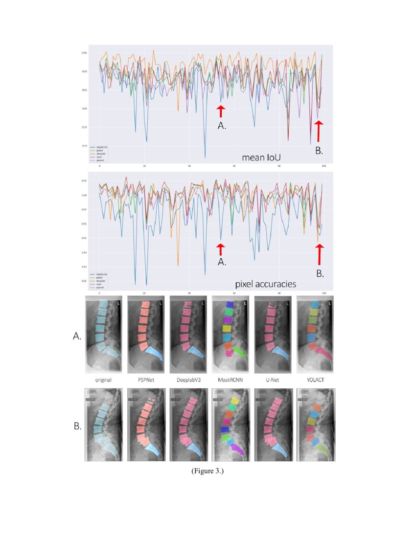Convolutional Neural Networks based automated segmentation and labelling of the lumbar spine X ...