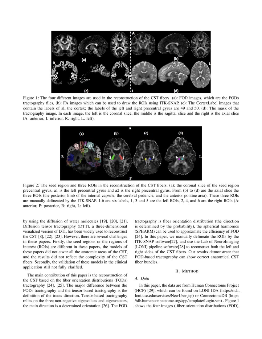 Corticospinal Tract (CST) reconstruction based on fiber orientation ...