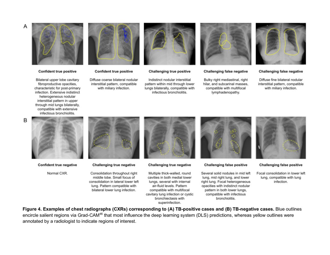 Deep learning for detecting pulmonary tuberculosis via chest ...