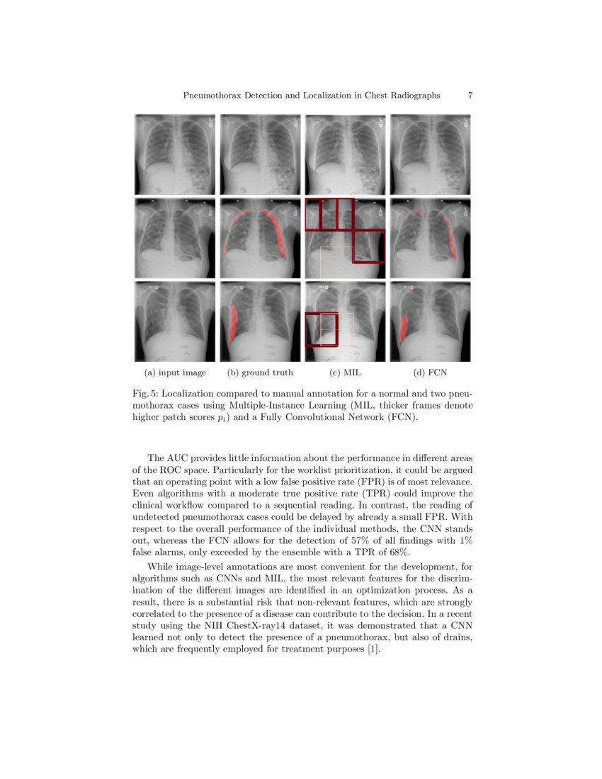 Deep Learning For Pneumothorax Detection And Localization In Chest