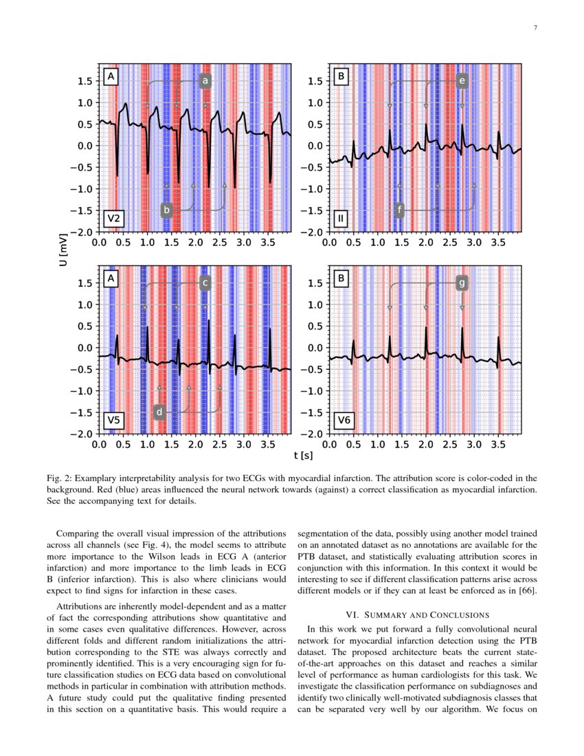 Detecting And Interpreting Myocardial Infarctions Using Fully