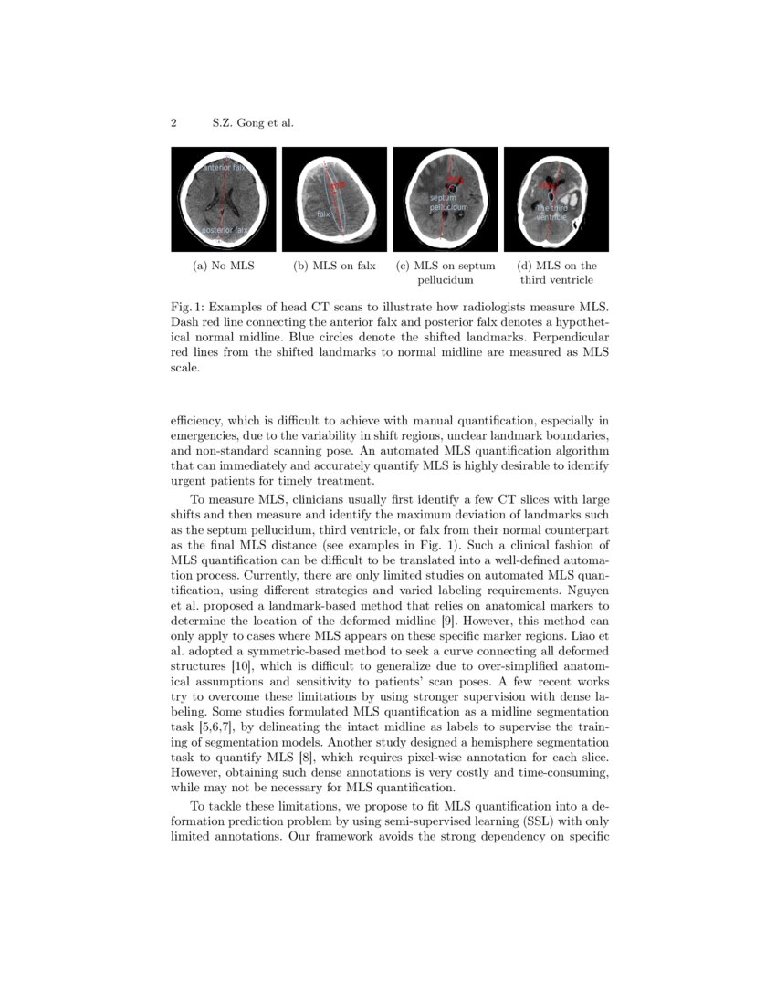 Diffusion Model based Semi-supervised Learning on Brain Hemorrhage Images for Efficient Midline ...