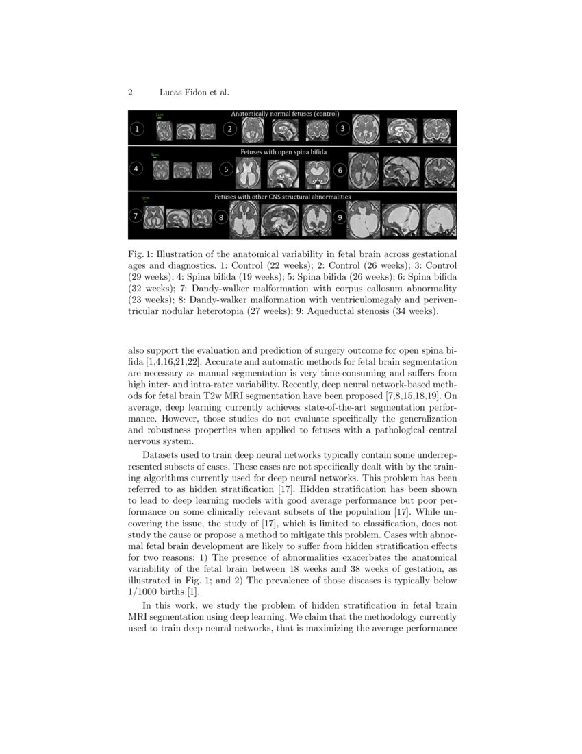 Distributionally Robust Segmentation Of Abnormal Fetal Brain 3d Mri