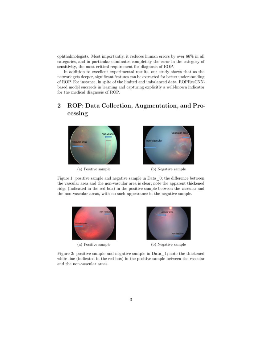 Early Detection of Retinopathy of Prematurity (ROP) in Retinal Fundus Images Via Convolutional ...