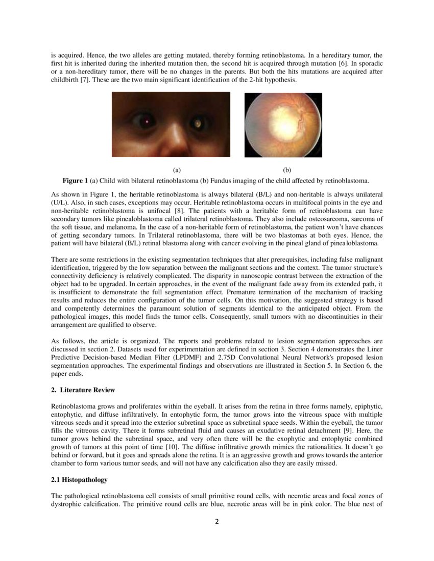 Early Prediction and Diagnosis of Retinoblastoma Using Deep Learning ...