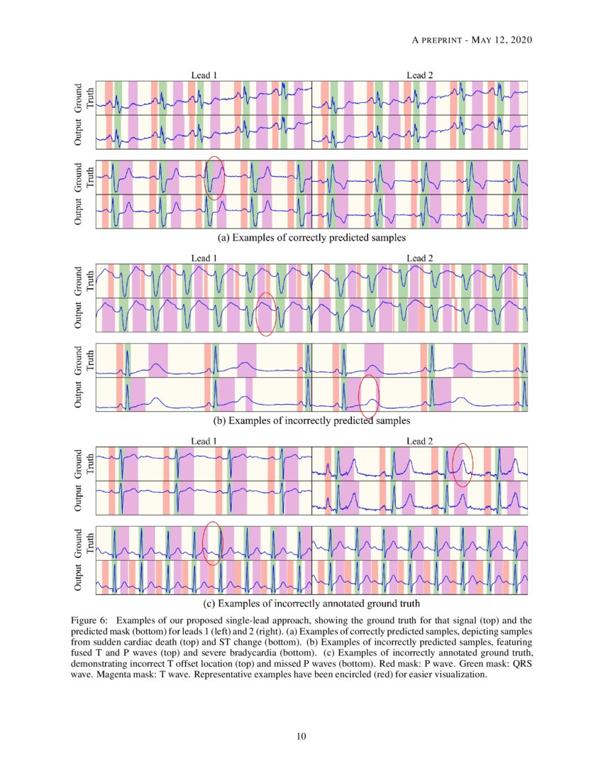 ECG-DelNet: Delineation of Ambulatory Electrocardiograms with Mixed Quality Labeling Using ...