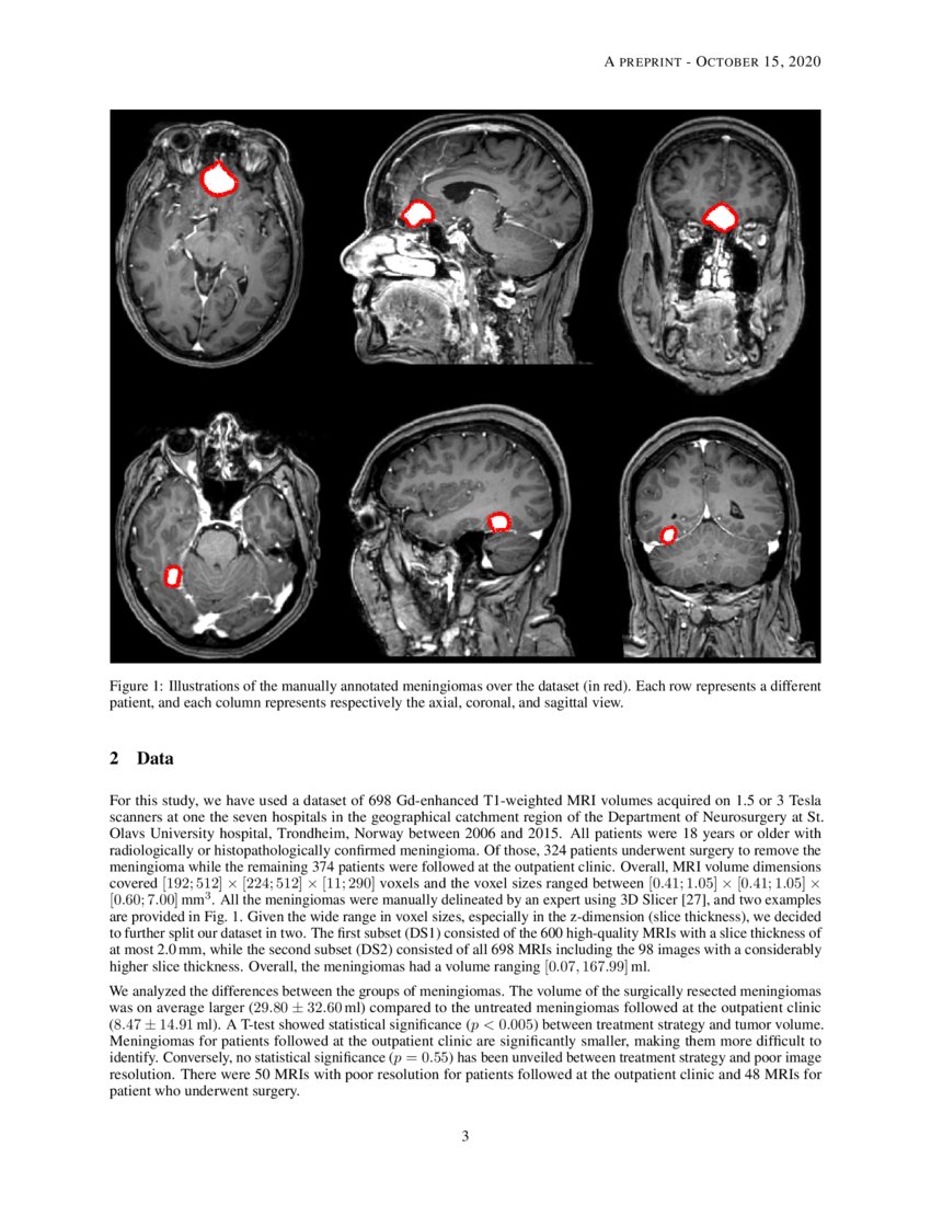 Fast meningioma segmentation in T1-weighted MRI volumes using a lightweight 3D deep learning ...