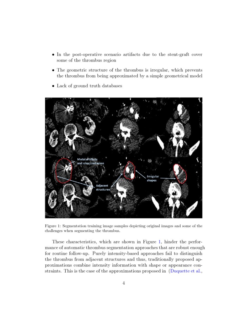 Fully Automatic Detection And Segmentation Of Abdominal Aortic Thrombus In Post Operative Cta