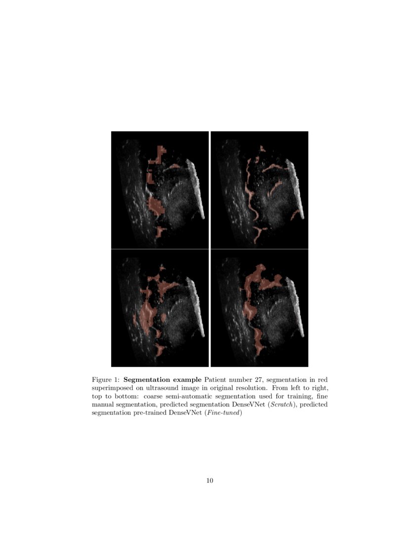 Fully Automatic Segmentation of 3D Brain Ultrasound: Learning from ...