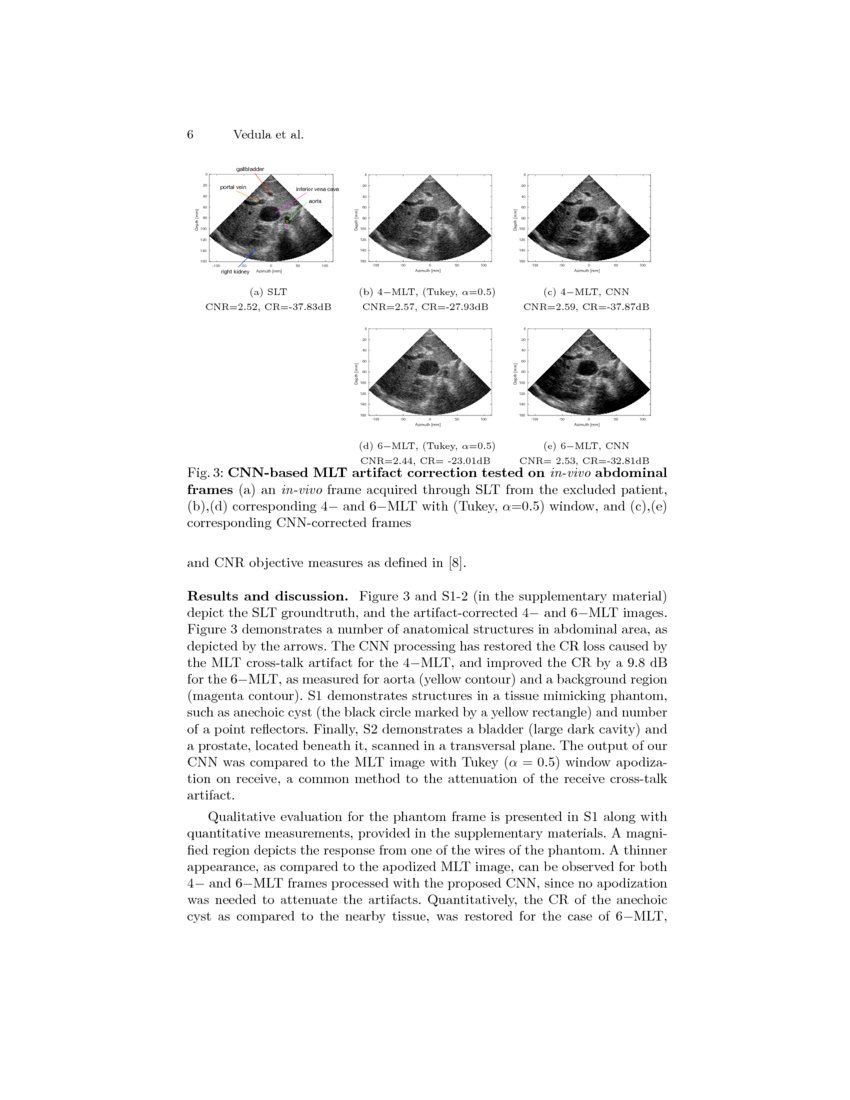 High quality ultrasonic multi-line transmission through deep learning ...