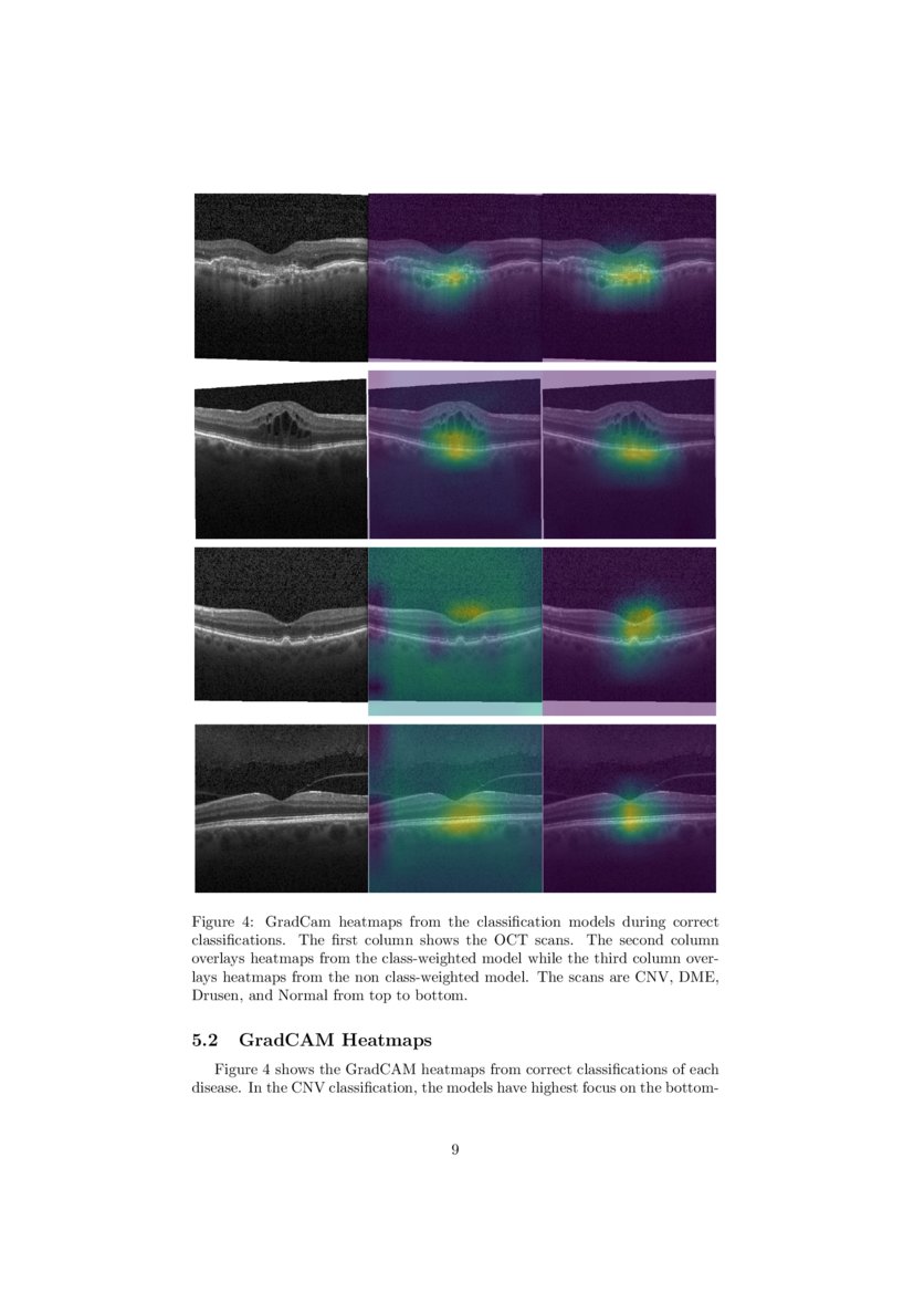 Interpretable Automated Diagnosis of Retinal Disease using Deep OCT Analysis | DeepAI