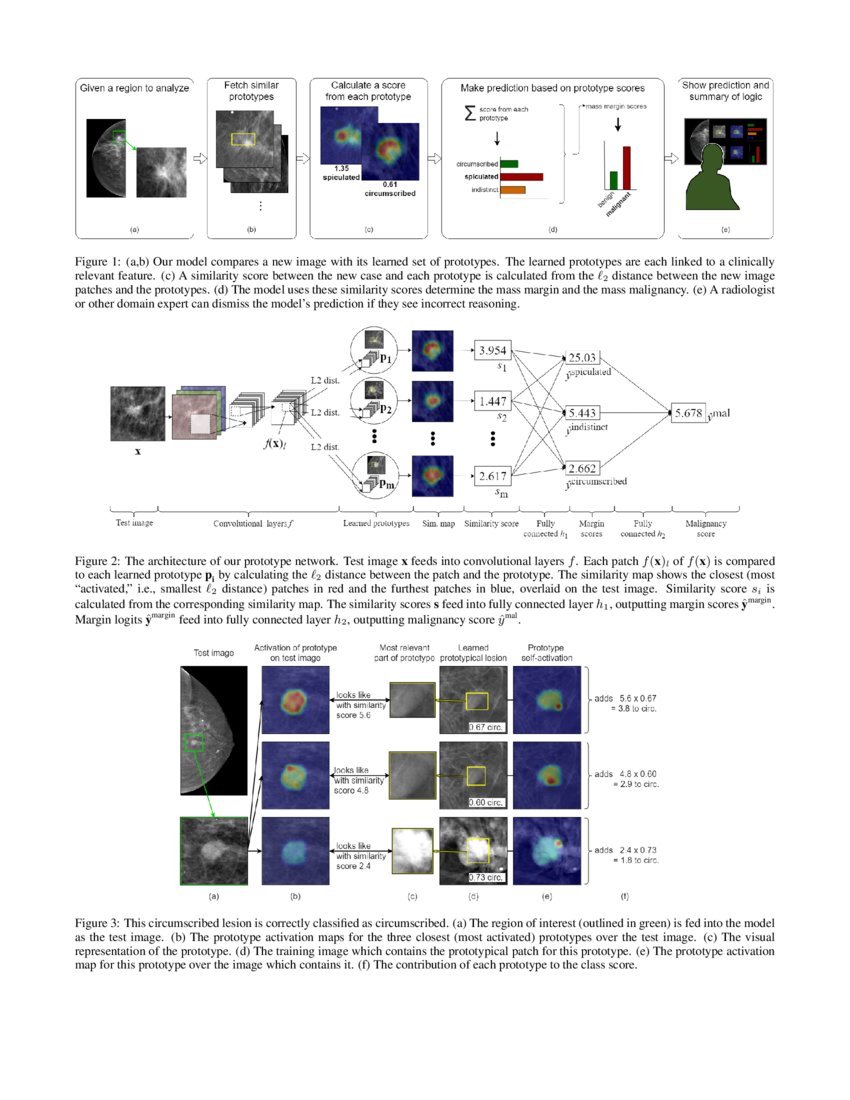 Interpretable Mammographic Image Classification using Cased-Based ...