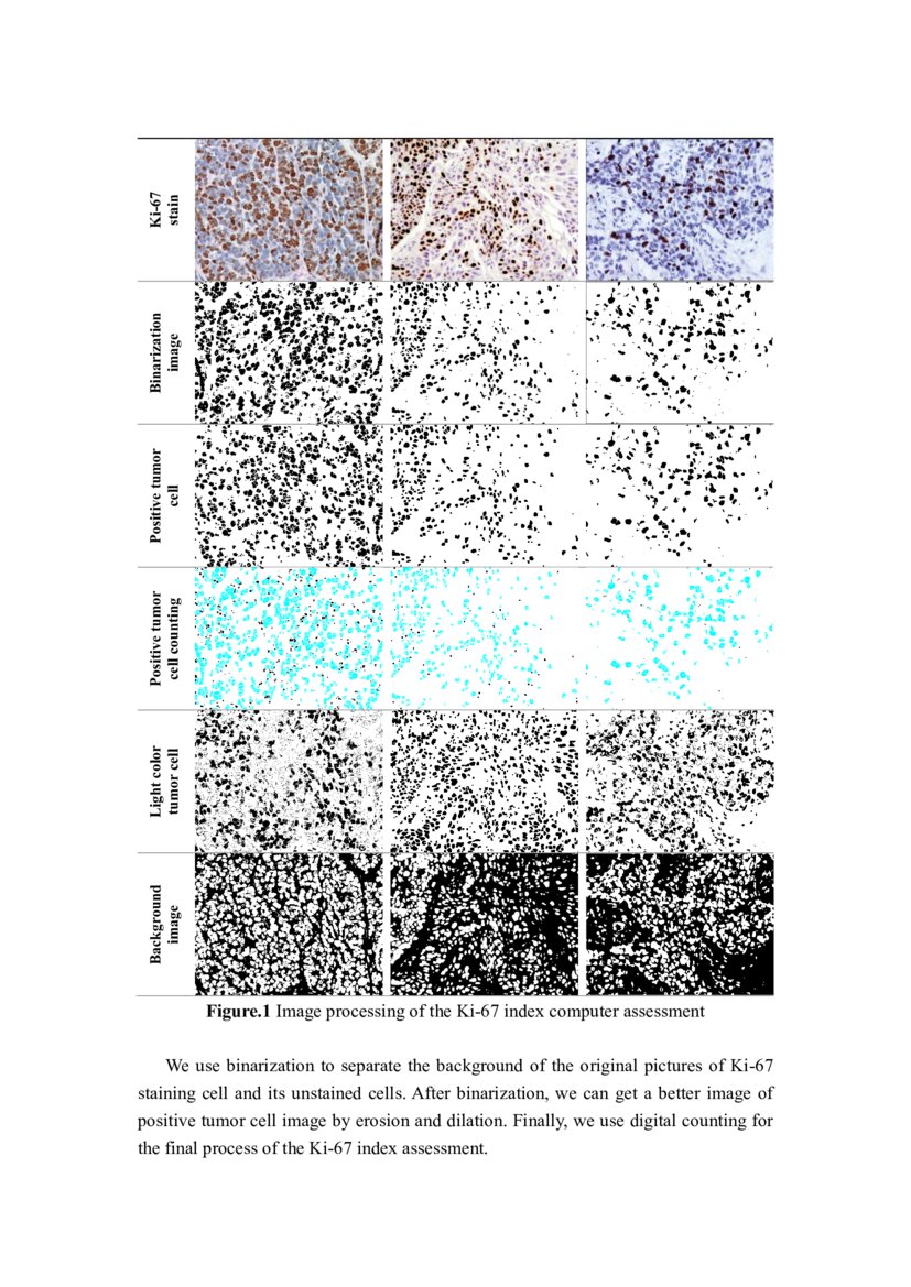 Ki-67 Index Measurement in Breast Cancer Using Digital Image Analysis | DeepAI