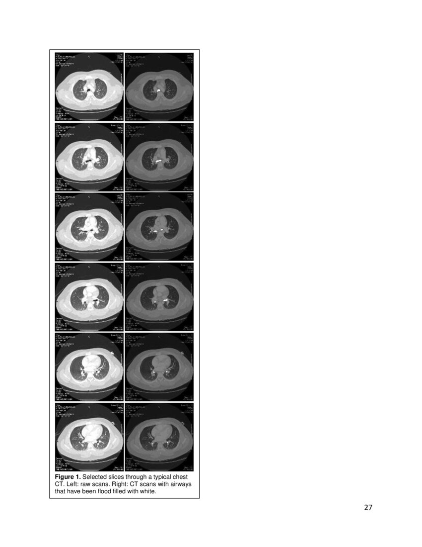 Lung airway geometry as an early predictor of autism: A preliminary ... Lung airway geometry as an early predictor of autism: A preliminary ...