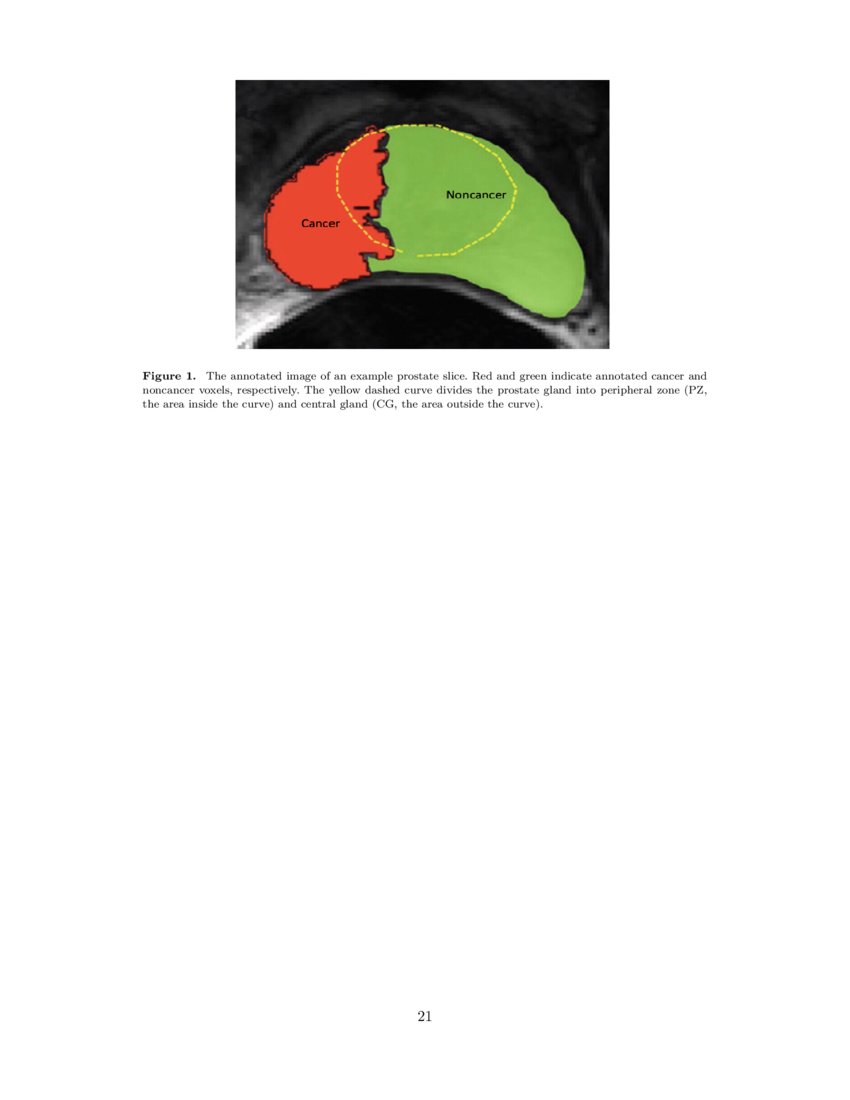 Multi-resolution Super Learner for Voxel-wise Classification of Prostate Cancer Using Multi ...