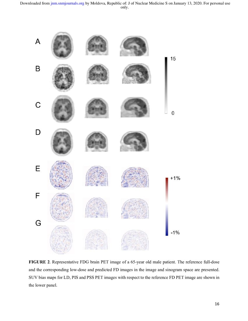Projection-space implementation of deep learning-guided low-dose brain ...