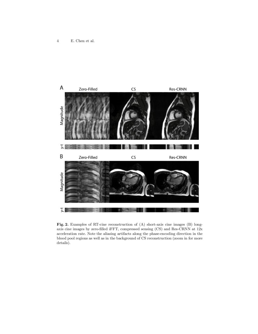 Real Time Cardiac Cine Mri With Residual Convolutional Recurrent Neural