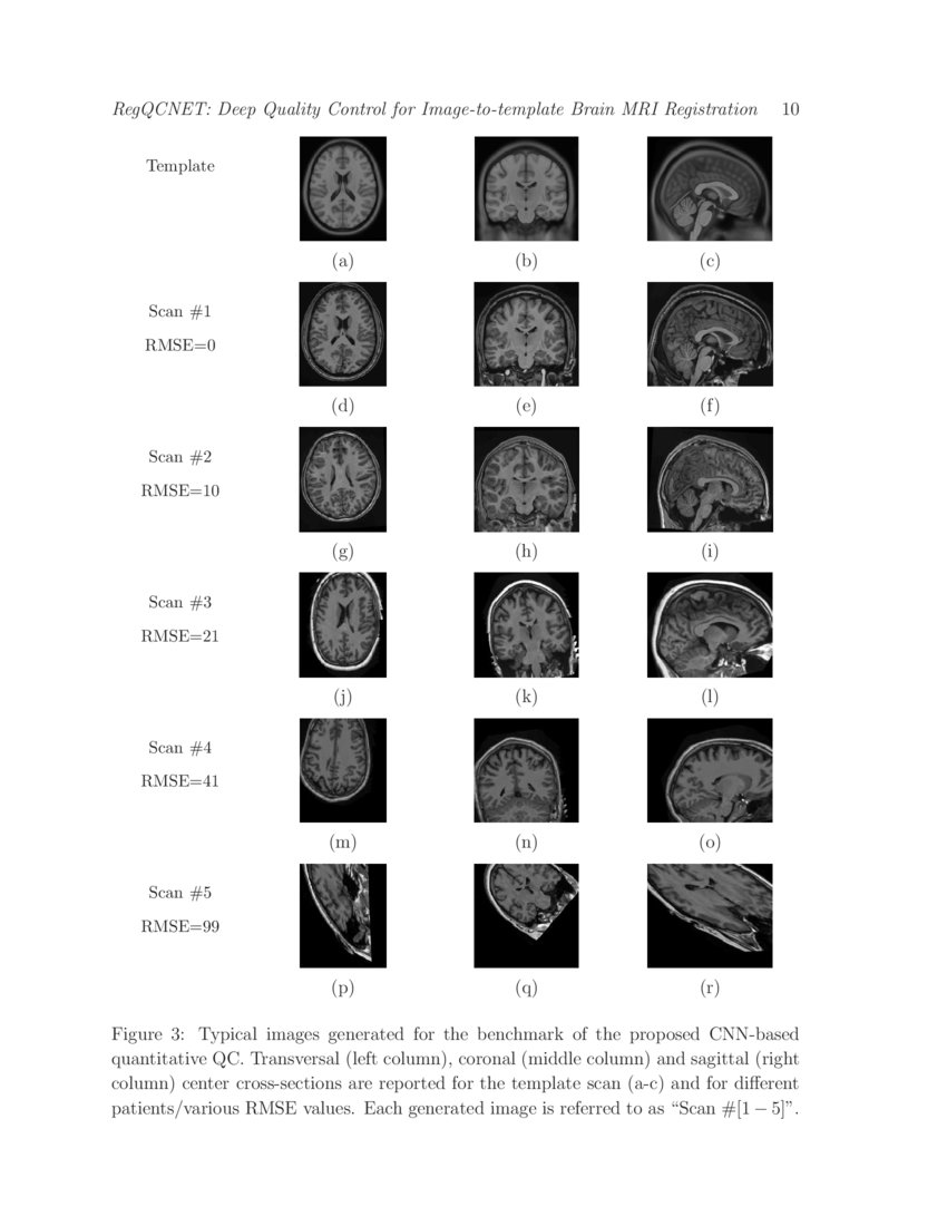 RegQCNET: Deep Quality Control for Image-to-template Brain MRI ...