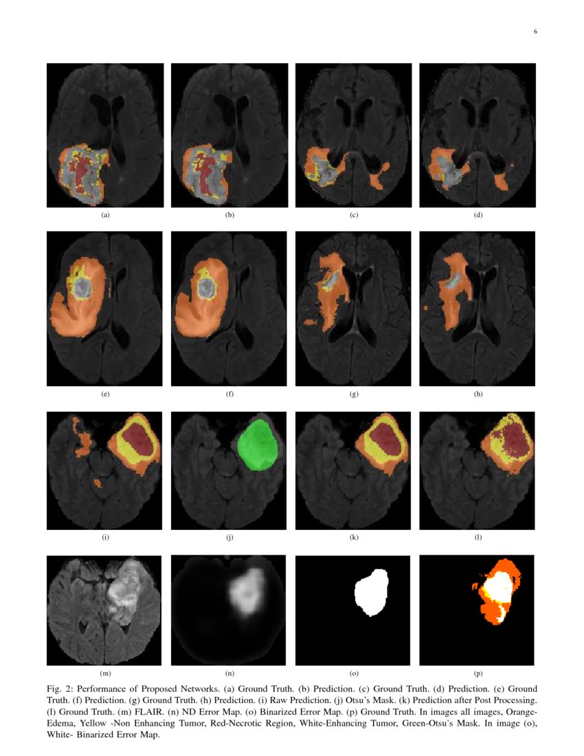 Semi Supervised Learning Using Denoising Autoencoders For Brain Lesion Detection And