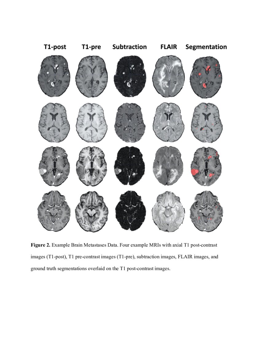 The University of California San Francisco, Brain Metastases ...