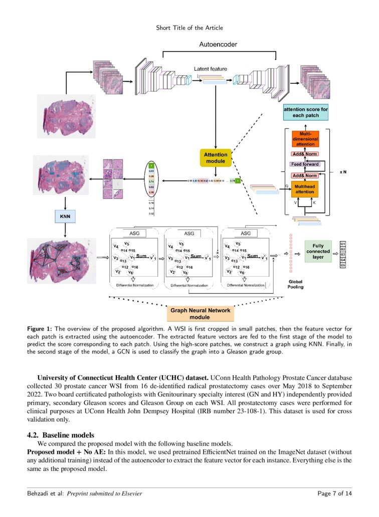 Weakly Supervised Deep Learning Model For Prostate Cancer Diagnosis And Gleason Grading Of